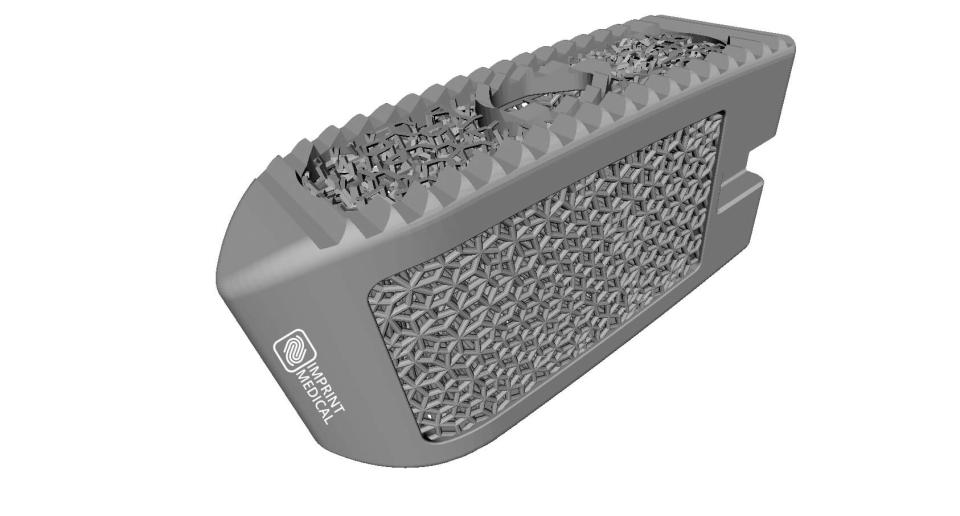 Imprint Medical Enhances Lattice-Based Implant Design with 3DXpert for ...