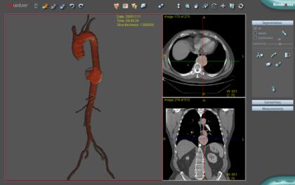 TEVAR - Thoracic Endovascular Aortic Repair | 3D Systems