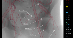 Prostatic Artery Embolization (PAE) | 3D Systems