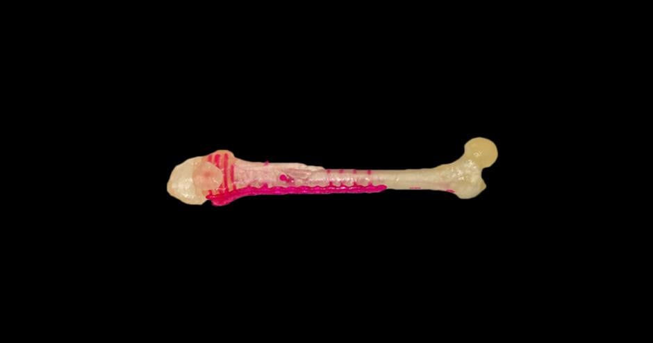 Femur fructure – ProX 800 | 3D Systems