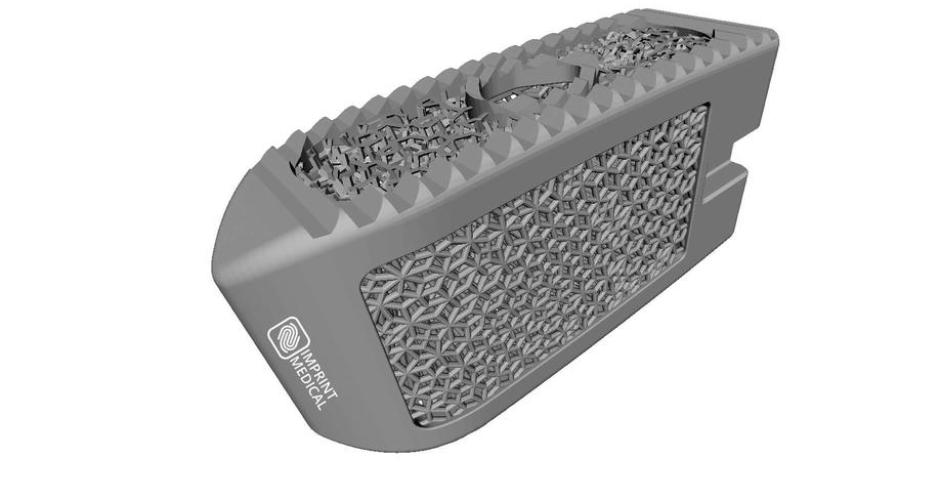 Imprint Medical Enhances Lattice-Based Implant Design with 3DXpert for ...