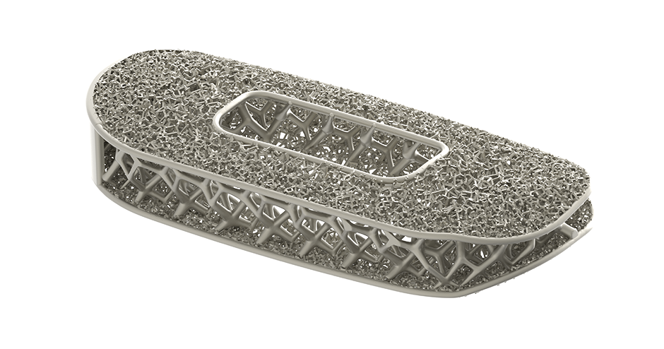 NuVasive Taps AM Ecosystem to Optimize Spine Implant Technology | 3D ...
