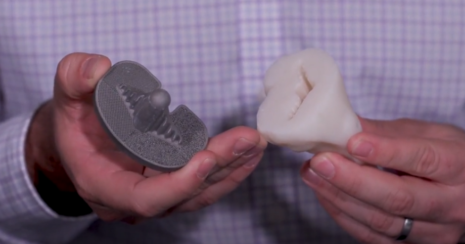 3D Printed Implants for Total Knee Replacement | 3D Systems