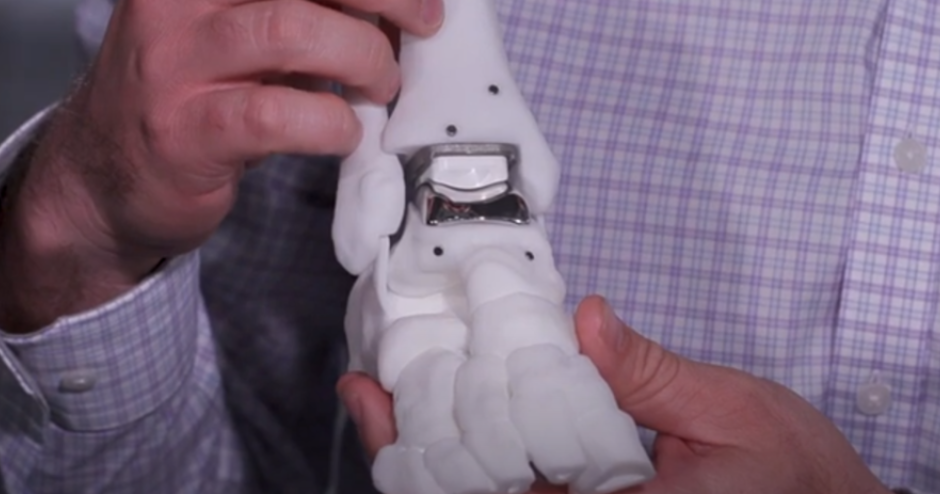 3D Printed Implants for Total Ankle Replacement | 3D Systems
