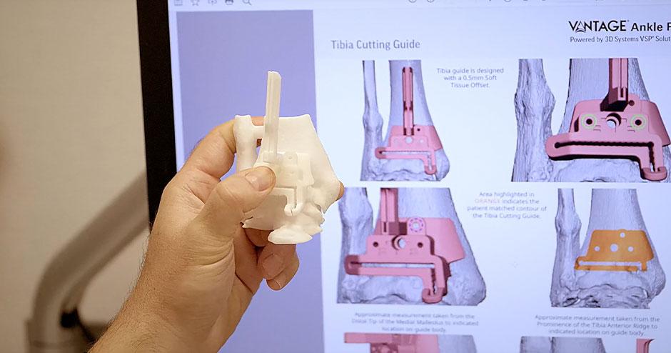 Patient-specific ankle replacement helps restore mobility for Florida ...
