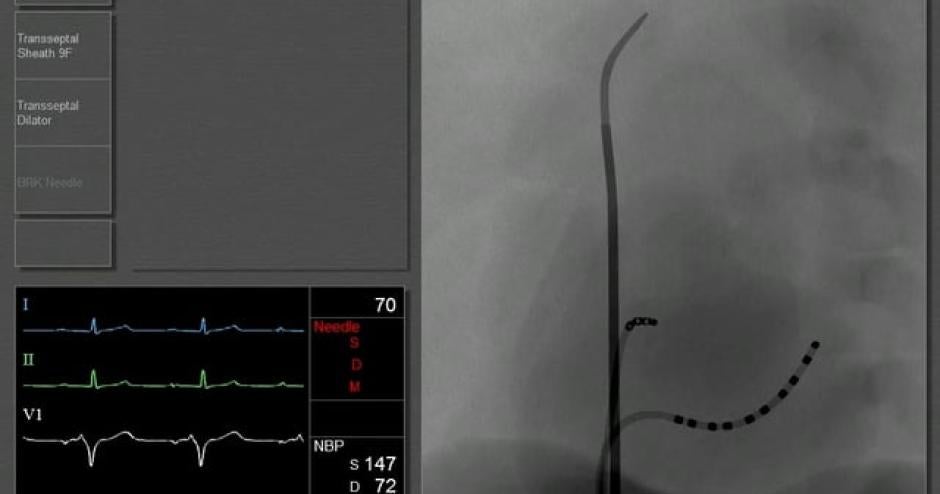 ANGIO Mentor - Transseptal Puncture | 3D Systems