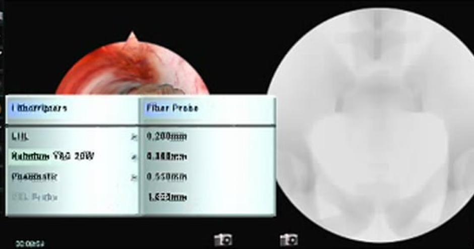 URO Mentor - Stone Manipulation | 3D Systems