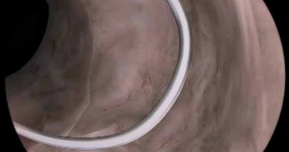 TURP Bleeding Control | 3D Systems