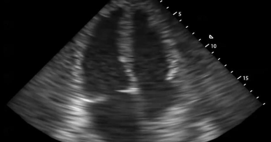 Video: U/S Mentor - McConnell's Sign in Pulmonary Embolism | 3D Systems